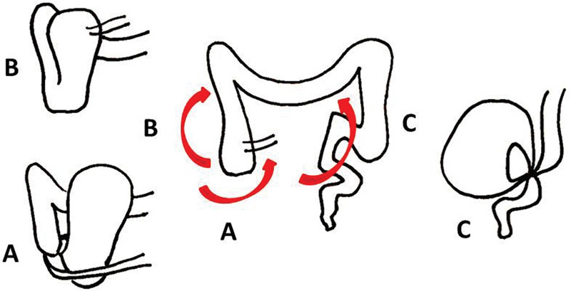 Article of interest: Volvulus of the Small Bowel and Colon | Surgical Focus