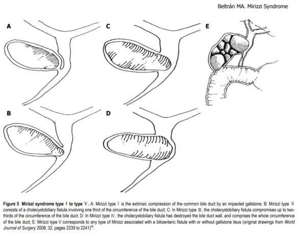 Classifications of Mirizzi Syndrome | Surgical Focus
