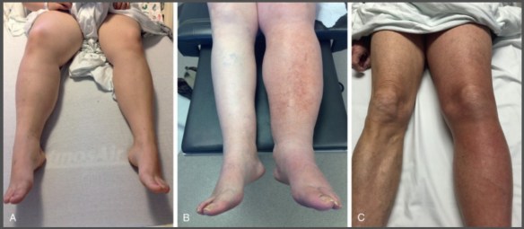 Phlegmasia alba dolens and phlegmasia cerulea dolens | Surgical Focus