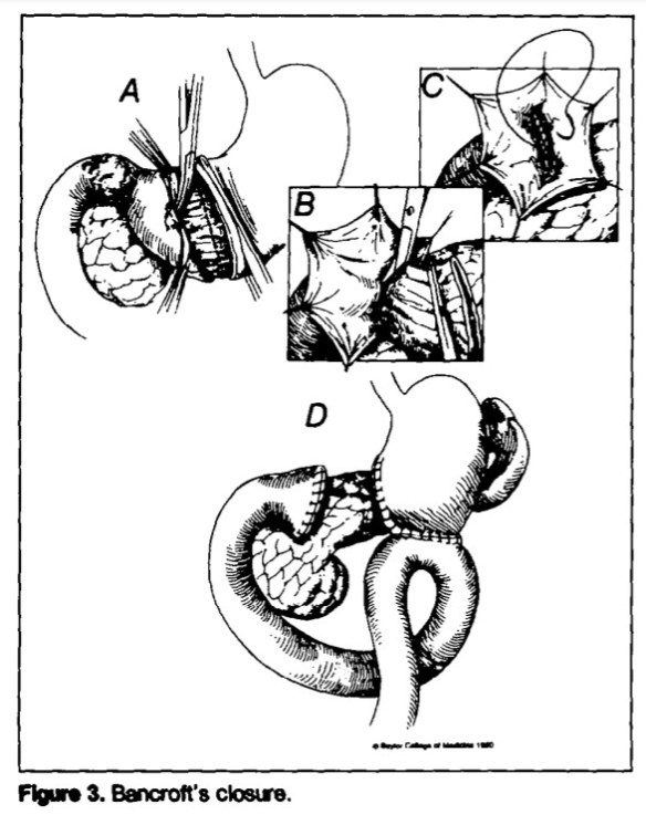 Management of the difficult duodenal stump | Surgical Focus