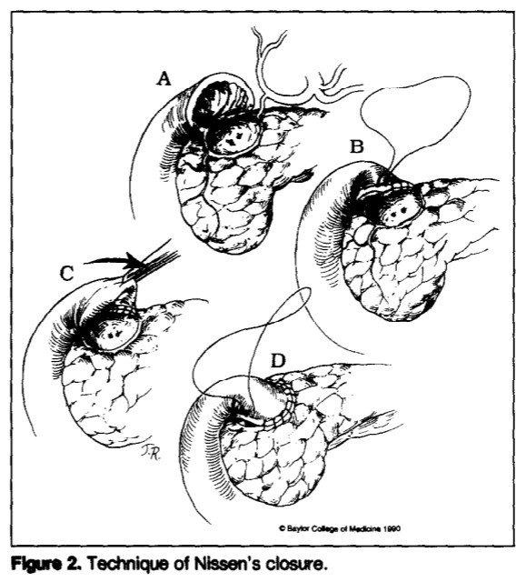 Management of the difficult duodenal stump | Surgical Focus