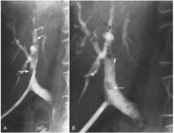 T-Tubes | Surgical Focus