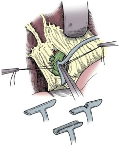 T-Tubes | Surgical Focus