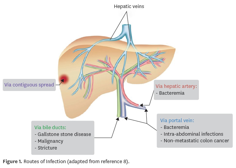 Klebsiella pneumoniae liver abscess | Surgical Focus