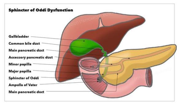 Sphincter of Oddi dysfunction | Surgical Focus