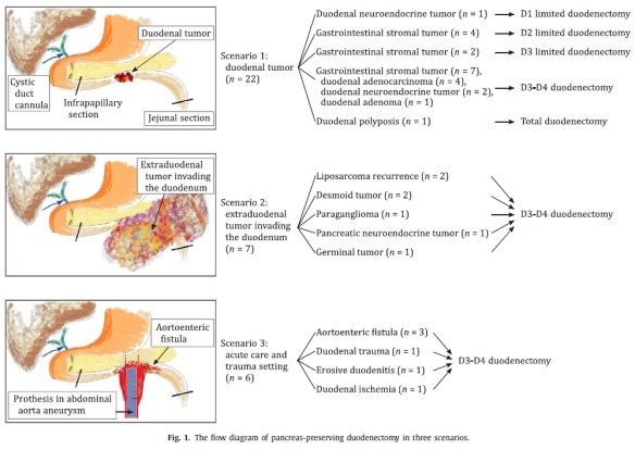 Pancreas-preserving duodenectomy | Surgical Focus