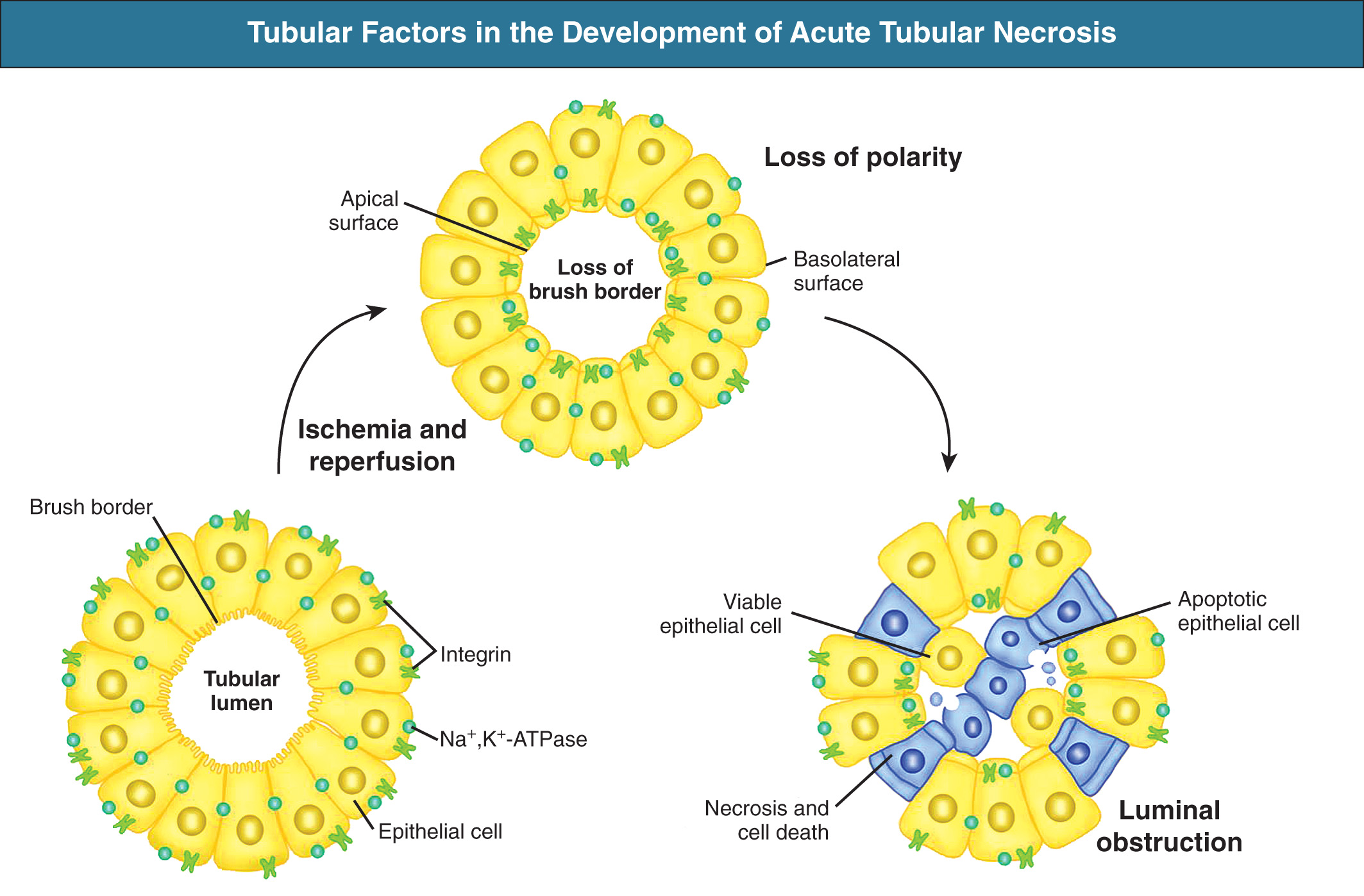 Pathologies of acute tubular necrosis | Surgical Focus