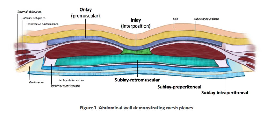 Mesh placement in ventral hernia repair | Surgical Focus
