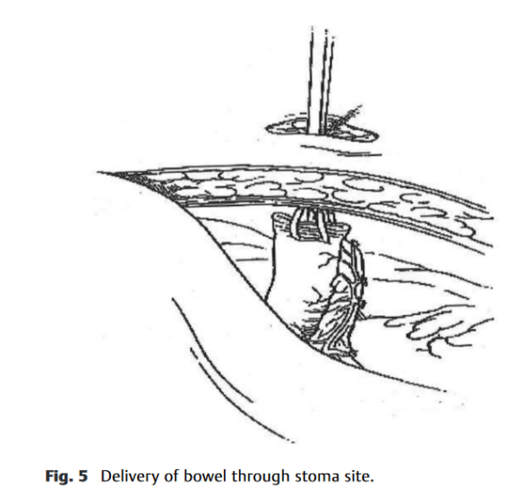 Creating an intestinal stoma | Surgical Focus