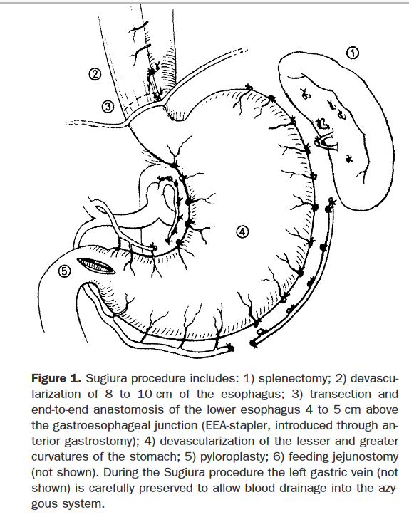 Indication of a Modified Sugiura Procedurein the Management of Variceal ...
