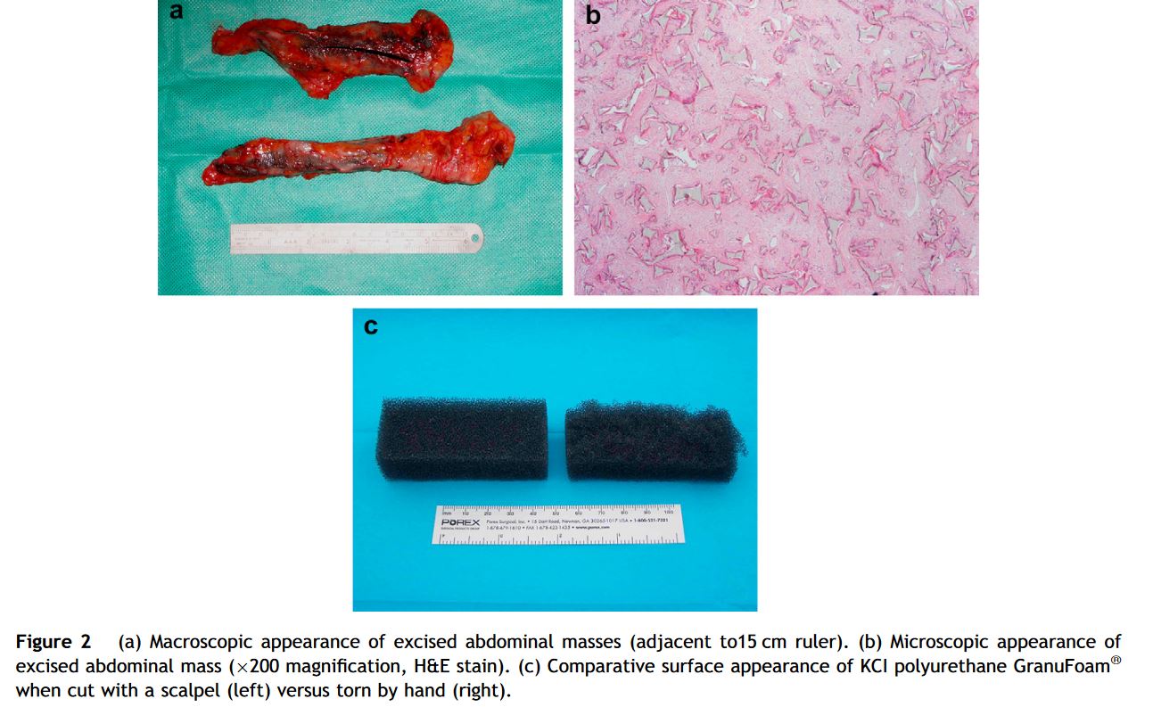 Retained wound VAC material as complication of abdominoplasty ...