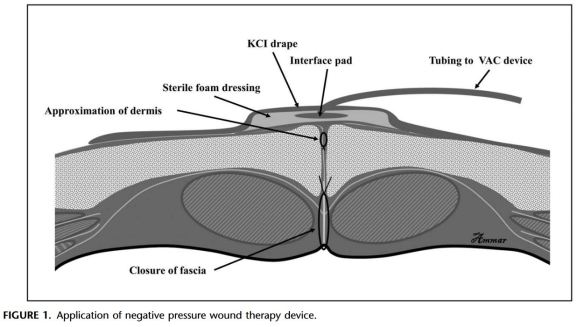 Infection Control | Surgical Focus