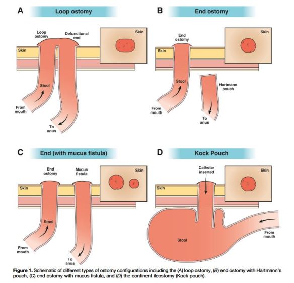 Clinical Practice Update on Management of Ostomies | Surgical Focus